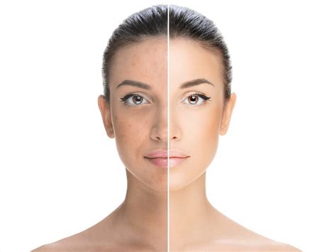 Acne Treatment Before And After Gallery Sp Derma Center