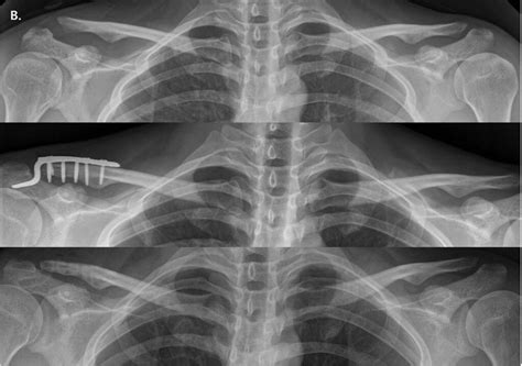 Acromioclavicular Ac Joint Subluxation And Dislocation Types Symptoms