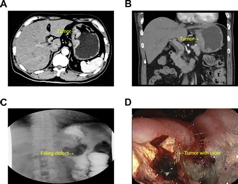 Laparoscopic Radical Gastrectomy For Remnant Gastric Cancer