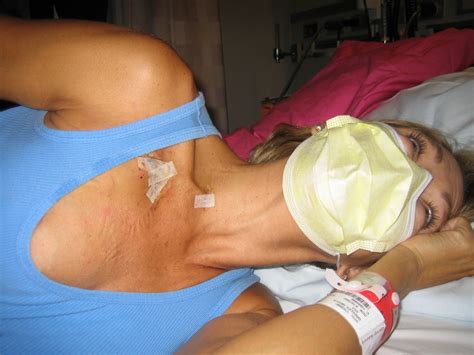 Heidi Vs Leukemia Day 16 Bone Marrow Test