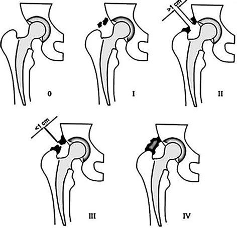 Spotting Heterotropic Ossification Dynamic Chiropractic