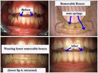 Spring Retainer Before And After