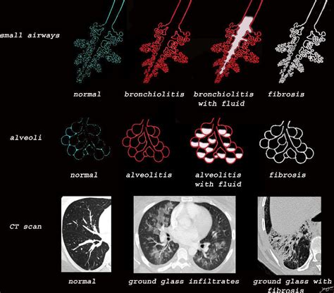 Art Of Lungs Opacity The Common Vein