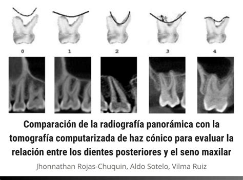 Pdf Comparación De La Radiografía Panorámica Con La Tomografía