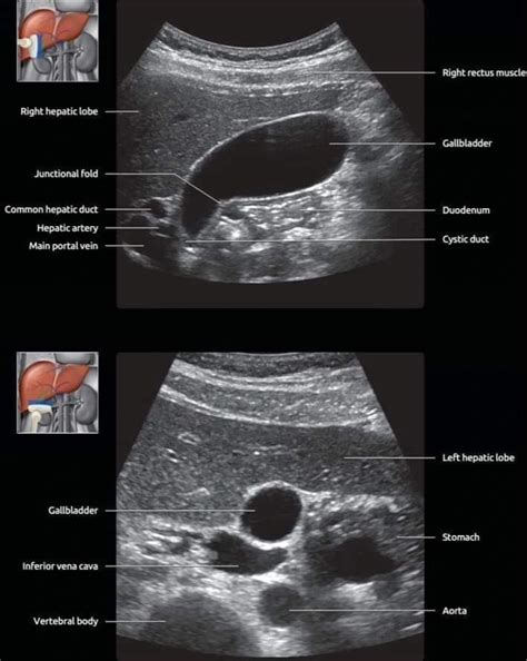 Gallbladder Longitudinal Lateral Decubitus Position Transverse Left Lateral Decubitus