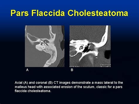 Infectious And Inflammatory Processes Of The Temporal Bone