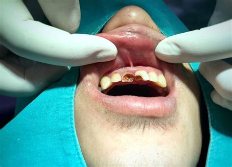 Tratamiento De Pulpitis Irreversible En Dientes Permanentes Adultos