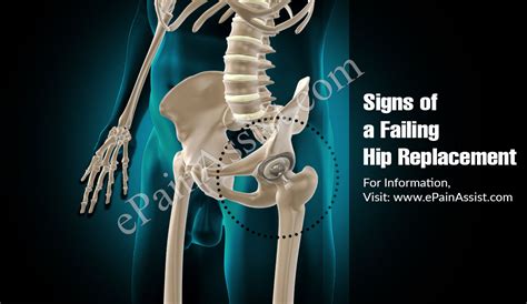Signs Of A Failing Hip Replacement