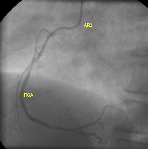 Cath Lab Angiography Views At Keith Joseph Blog