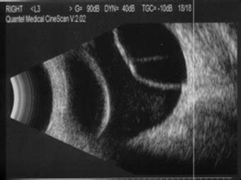 B Scan Ultrasonography And Ubm 9 10 Westmead Eye Manual