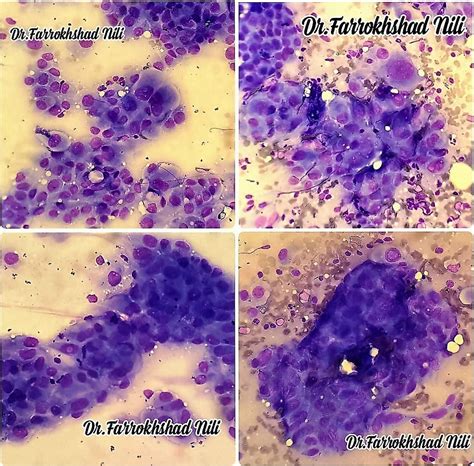 Farrokhshad Nili On Linkedin Left Thyroid Nodule Aspiration From A 32