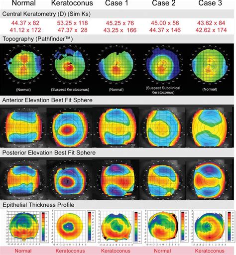 Epithelial Thickness Mapping For Keratoconus Screening By Vhf Digital Ultrasound Or Anterior