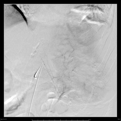 Radiopaedia Case Delayed Splenic Rupture Id 28571 Study 28825 Nc