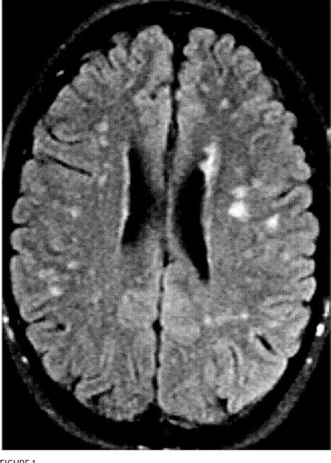 Figure 1 From Brain Abnormalities In Patients With Hyperimmunoglobulin