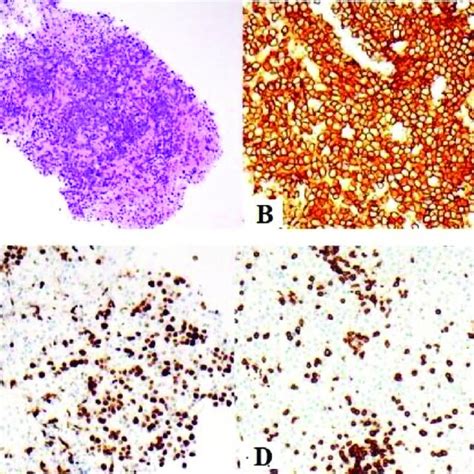 A Biopsy Showed Diffuse Proliferation Of Medium To Large Lymphoid Download Scientific Diagram
