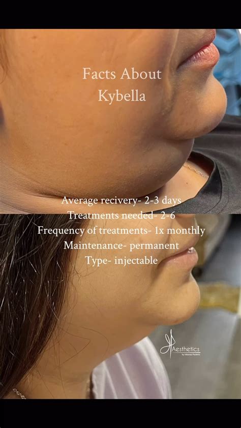 Kybella Injection Risks And Side Effects