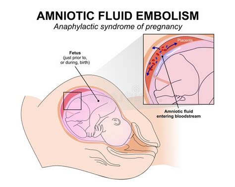 Placenta Amniotic Fluid Stock Illustrations 427 Placenta Amniotic