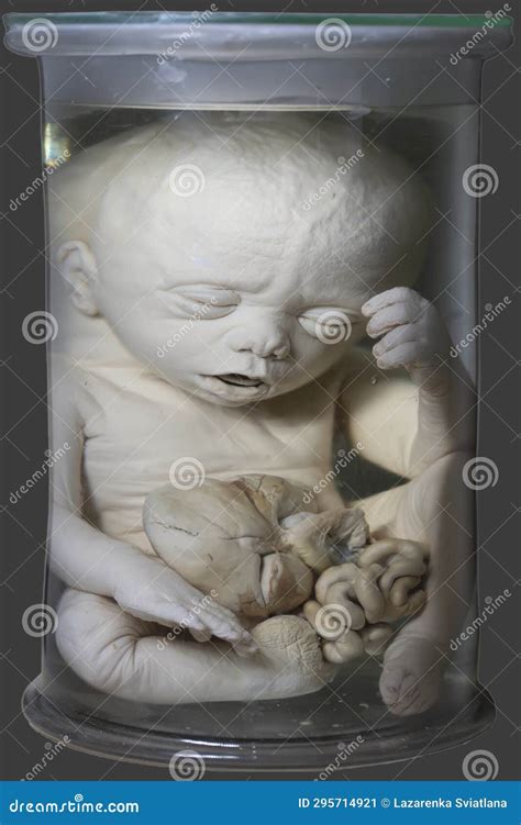 Human Infant With Pathological Development Of Microcephaly Human Dwarf Editorial Photo Image