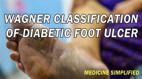 Wagner Classification Of Diabetic Foot Ulcers Diabetic Foot Ulcers