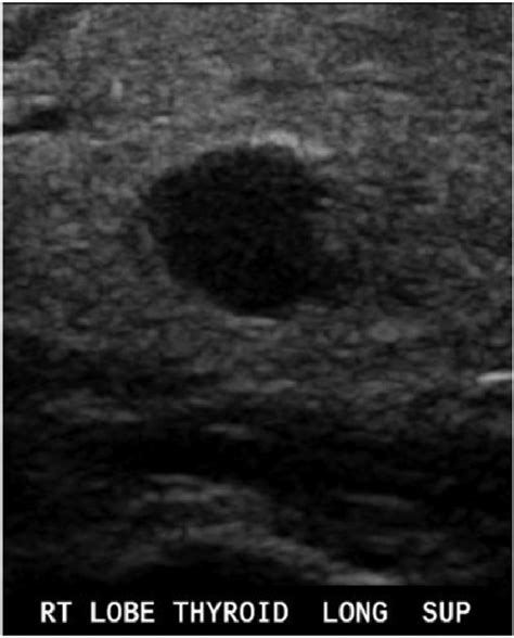 Thyroid Nodule With Marked Hypoechogenicity Download Scientific Diagram