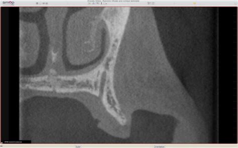 Hard Tissue Augmentation Using An Allogenic Bone Block A Clinical Case