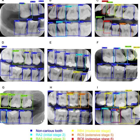 Samples Of Bitewing Radiographs Showing Ground Truth Manual Annotations Download Scientific