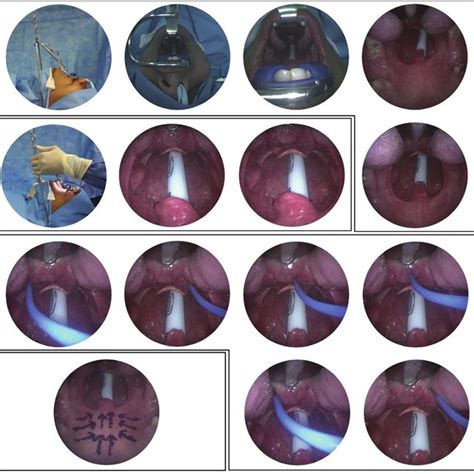 Rera Example With Increased Respiratory Effort Leading To An Arousal Download Scientific Diagram