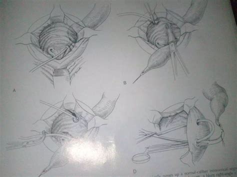 Megaureter Ppt Types Pathophysiology Evaluation And Management Pptx