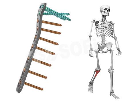 Locking Lateral Tibia Plate Titanium At ₹ 2850piece In New Delhi Id