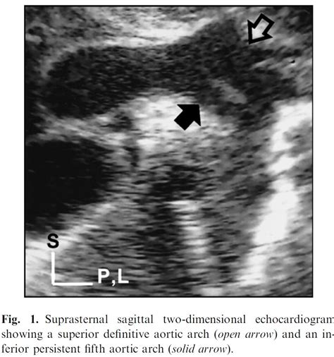 Pedi Cardiology Persistent Fifth Arch