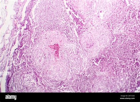 Histopathology Of Lymph Nodal Tuberculosis Light Micrograph Hematoxylin And Eosin Staining
