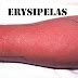 Erysipelas Definition Clinical Features And Complications Humainology