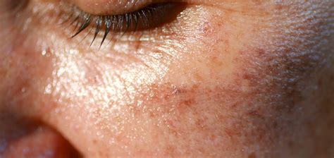 5 Tips For Treating Hyperpigmentation Best Serum To Treat