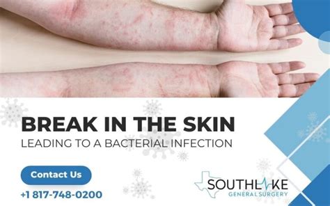 Cellulitis Causes Treatments And Recovery Southlake General Surgery