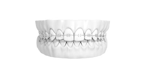 How Do Compression Braces Work At Tashia Saenz Blog