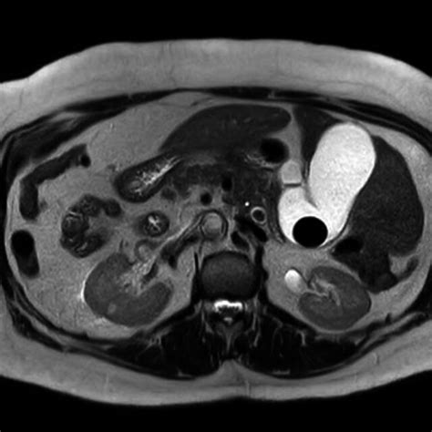 Cystic Ductotomy And Wire Guide Inserted Through The Duct Download