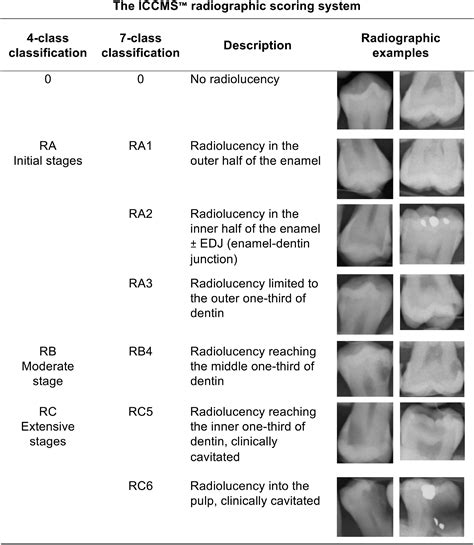 Icdas Caries Classification 4d System Cariescare International
