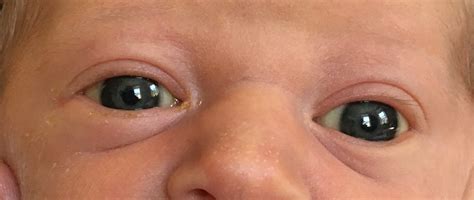 Pediatric Pearls Infants Eye Part 2 Color Discharge And Red Reflexes