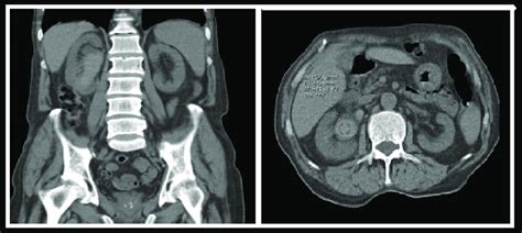 Hyperdense Space Occupying Lesion Extending From The Right Renal Pelvis