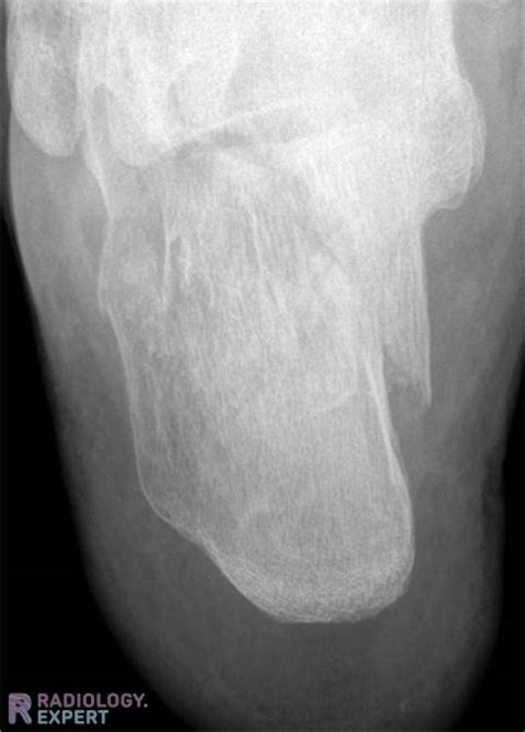 Calcaneus Fracture Axial View