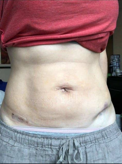 Why I Chose To Have My Ovaries Removed Brca1 And Laparoscopic