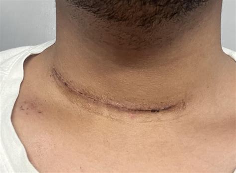 Thyroidectomy Scar Tips R Thyroidcancer