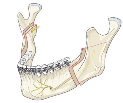 What Is A Bilateral Sagittal Split Osteotomy Archwired