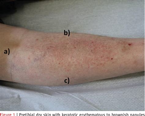 Pdf A Case Report And Differential Diagnosis Of Pruritic Pretibial
