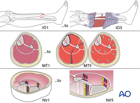 Principles Of Management Of Open Fractures