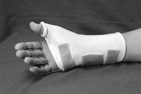 Rehabilitation Following Thumb Cmc Radiocarpal And Druj Arthroplasty