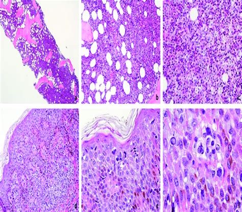 Bone Marrow Involvement In Atll A An Interstitial Spread Pattern Is Download Scientific