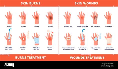 How To Look After A Burn On Hand At Cameron Malone Blog