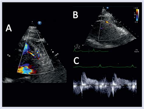 A Modified Parasternal Short Axis View Color Doppler Flow Mapping In Download Scientific