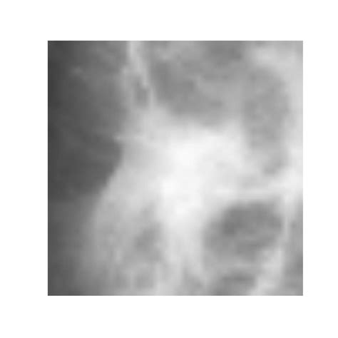 Mias Mammography Rois Kaggle